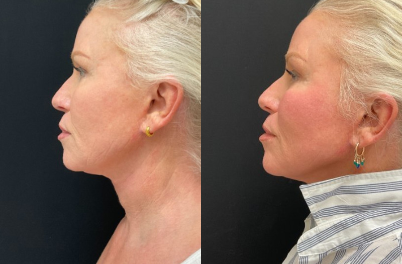 Ellacor Before & After Photos Encinitas, CA